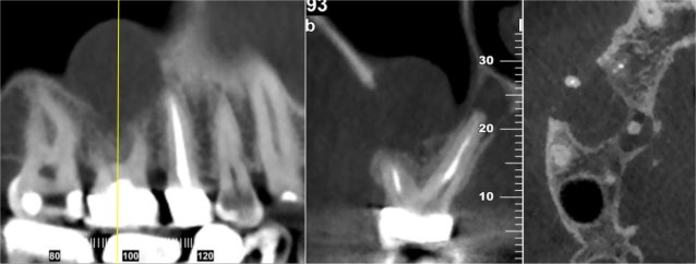 CBCT Endodontic Scan – ddi Imaging Centers